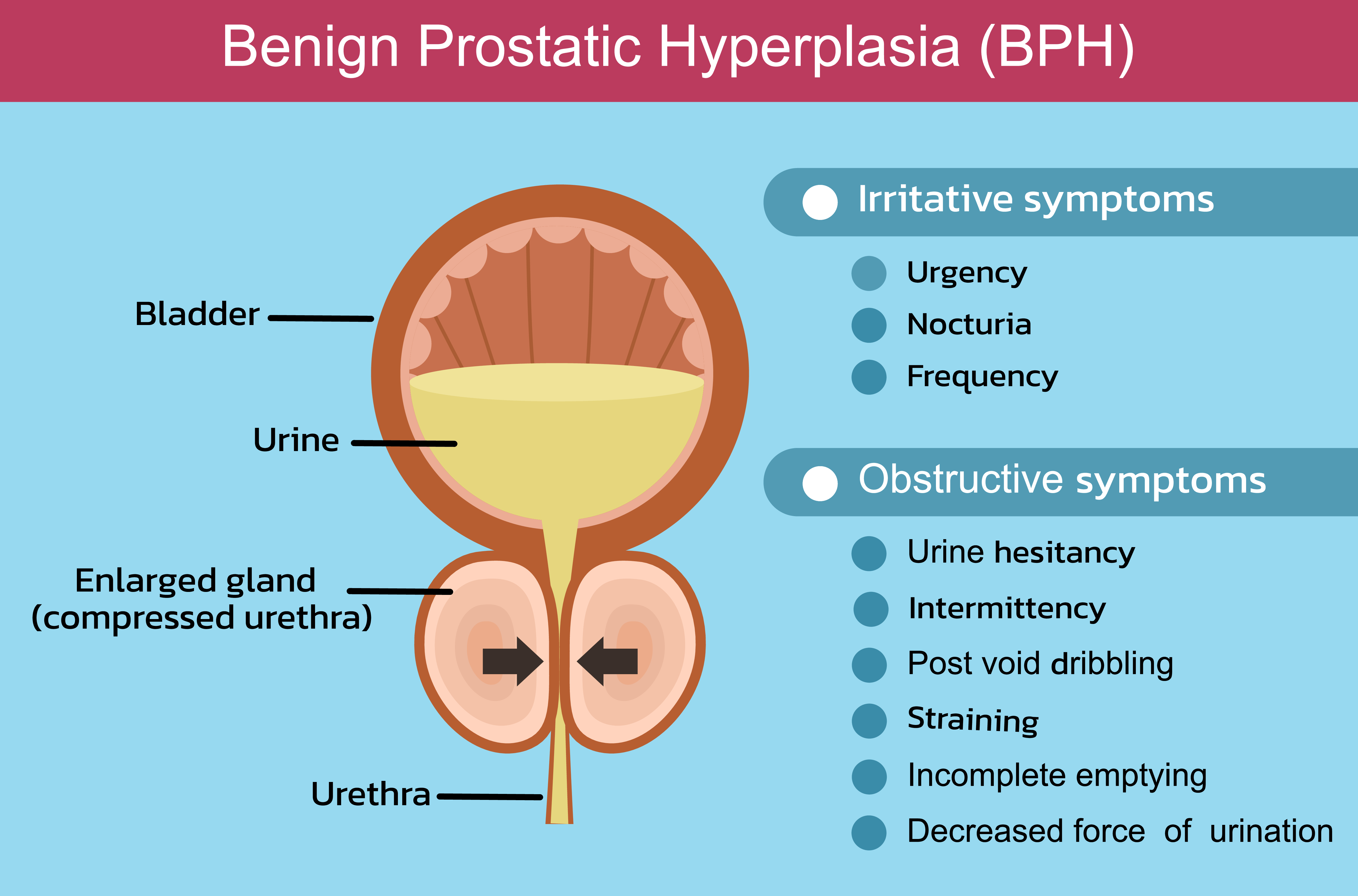 Office-based Treatment for BPH | UACC
