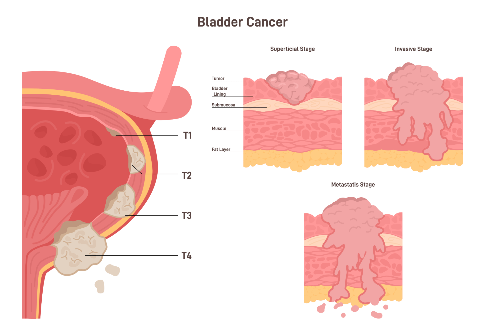 Bladder Cancer - Urology Associates of the Central Coast